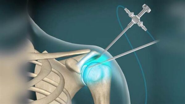 What is Shoulder Arthroscopy and Why It's Preferred? - Dr. Dineysh Dhytadak
